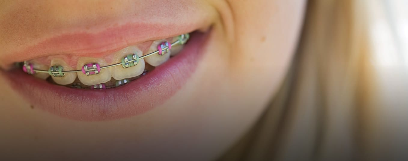 Career-Friendly Orthodontics: Choosing the Least Noticeable Treatment ...